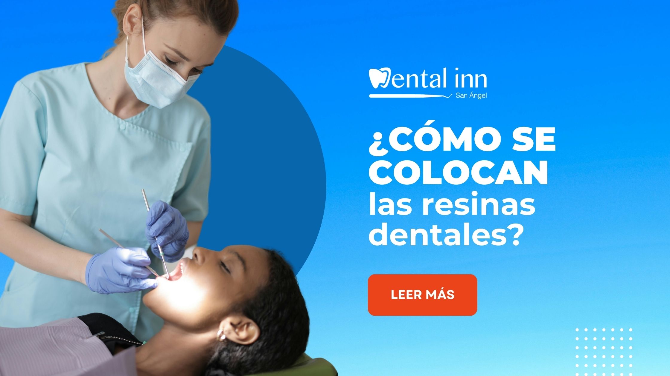 ¿cómo Se Colocan Las Resinas Dentales Dental Inn San Ángel